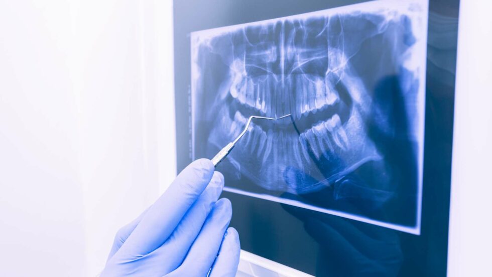 Greffe osseuse des dents : tout ce qu'il faut savoir